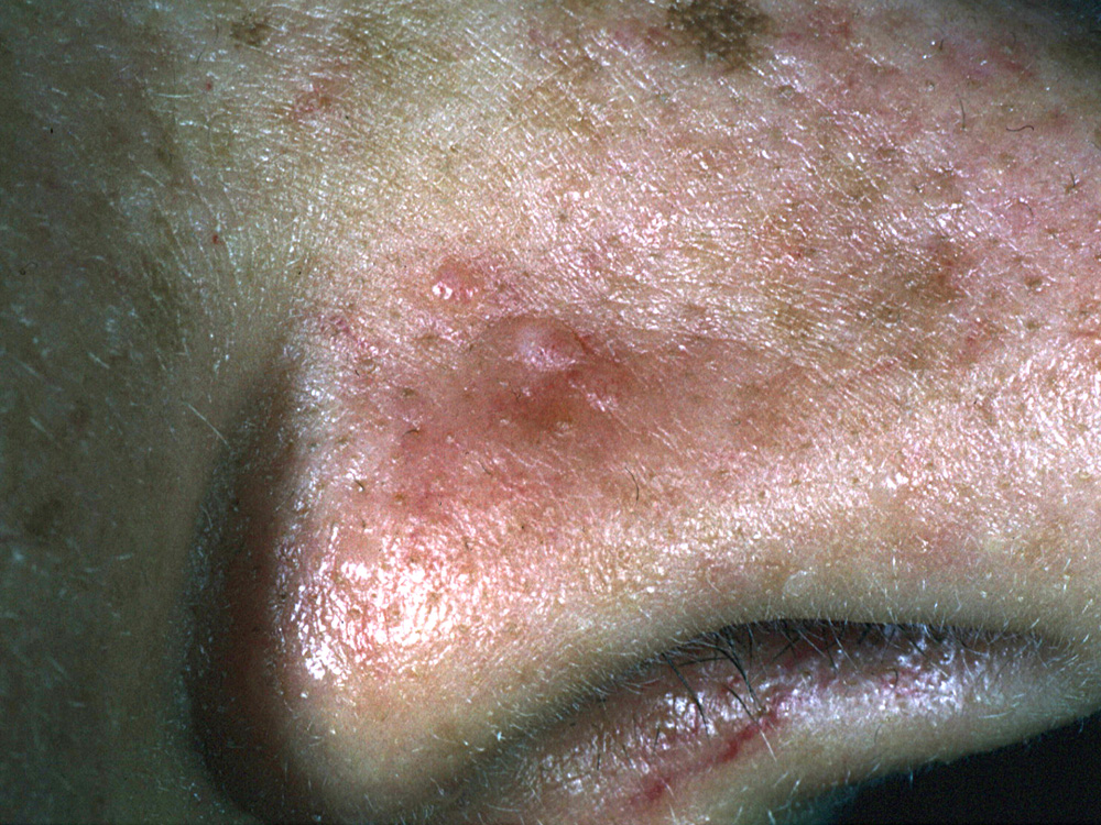 fibrous papule