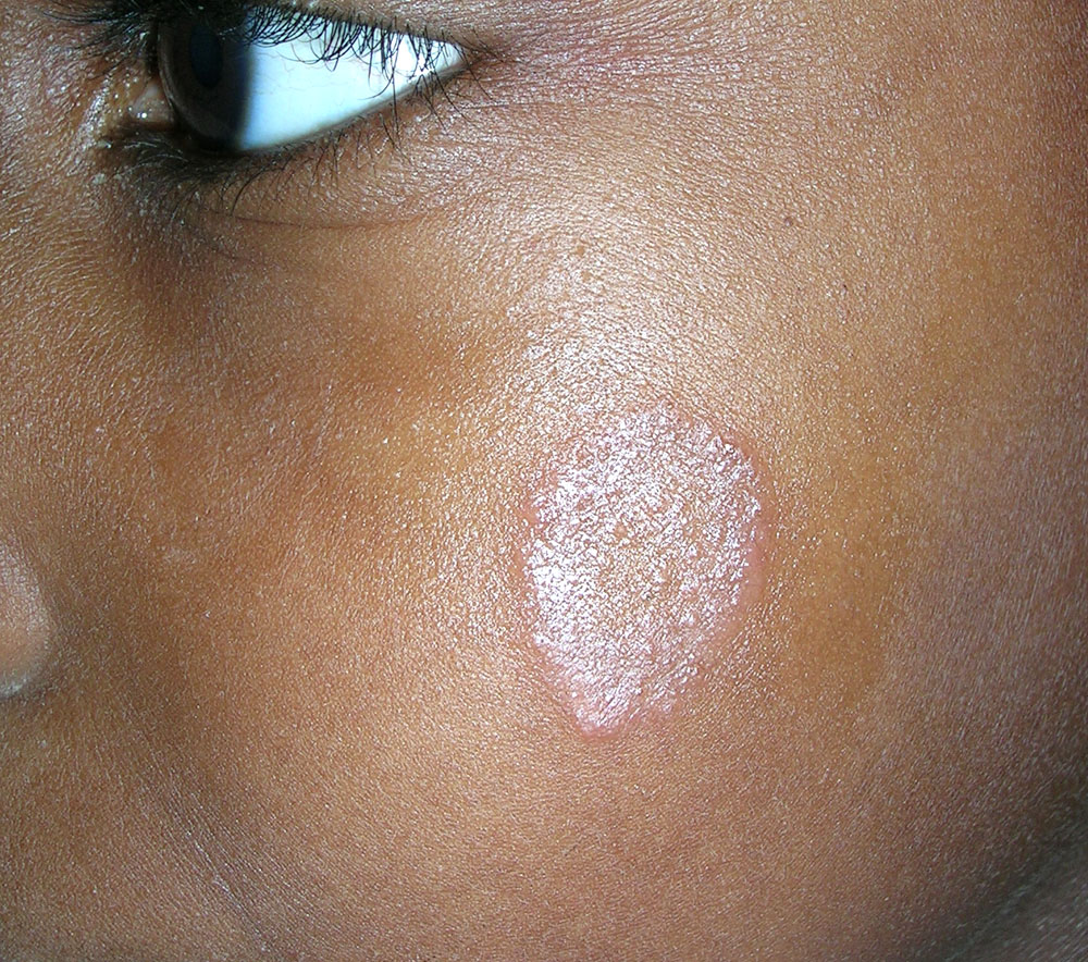tinea of the face