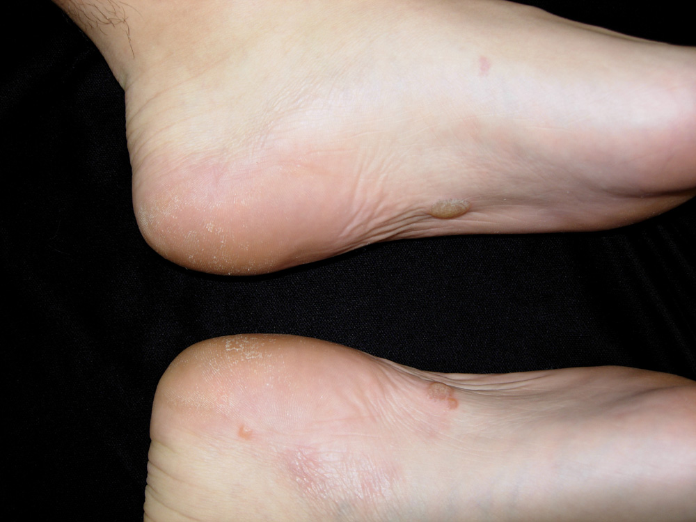 traction blister