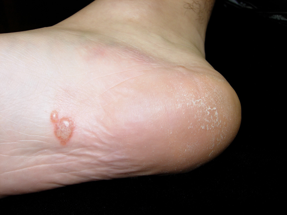traction blister